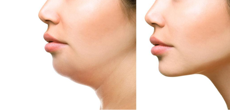 ¿Qué es la técnica del Mewing? | Zona 3 Equilibrio Perfecto | Reporte ...